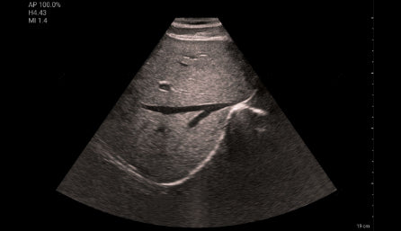 Liver – Mindray UK Online Store